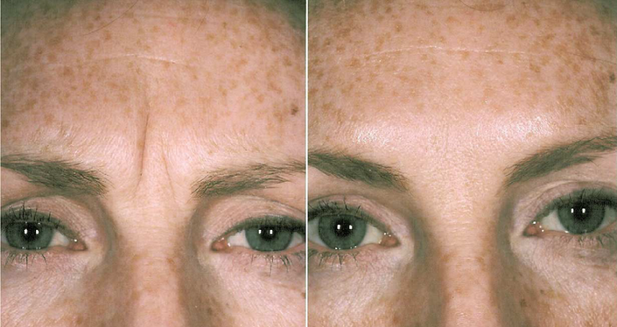 Aesthetic uses of Botulinum toxin A in the periocular region and mid ...